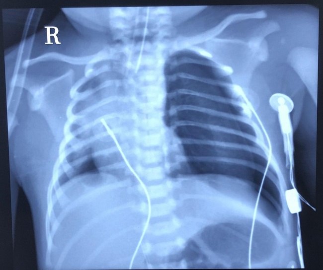 Penggunaan Chest Tube Drainage VS Aspirasi Jarum Pada Kasus Primary ...
