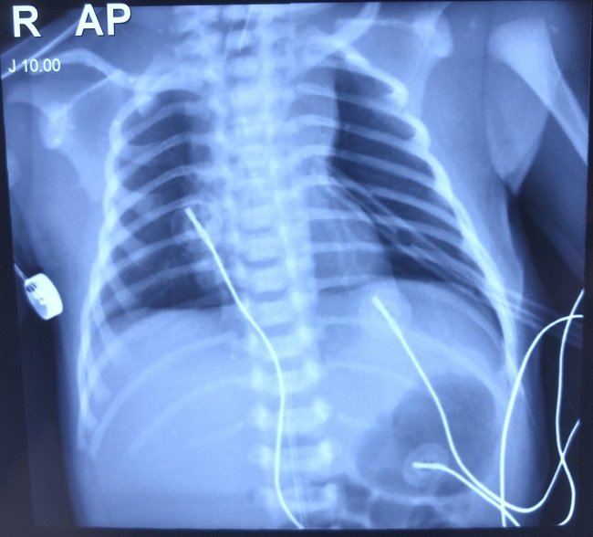 Penggunaan Chest Tube Drainage VS Aspirasi Jarum Pada Kasus Primary ...