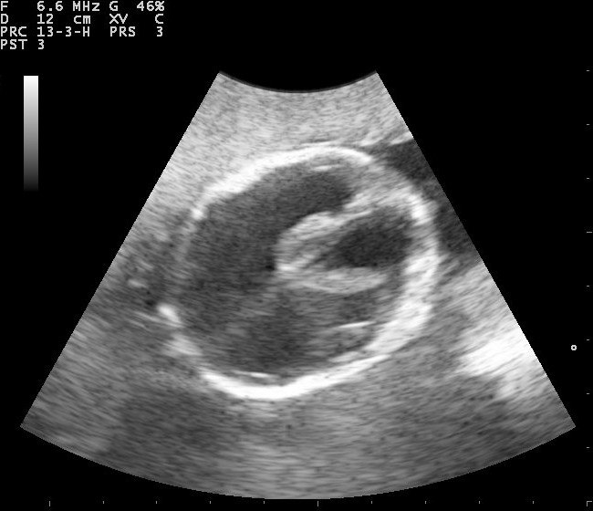 Diagnosis Hydrocephalus - Alomedika