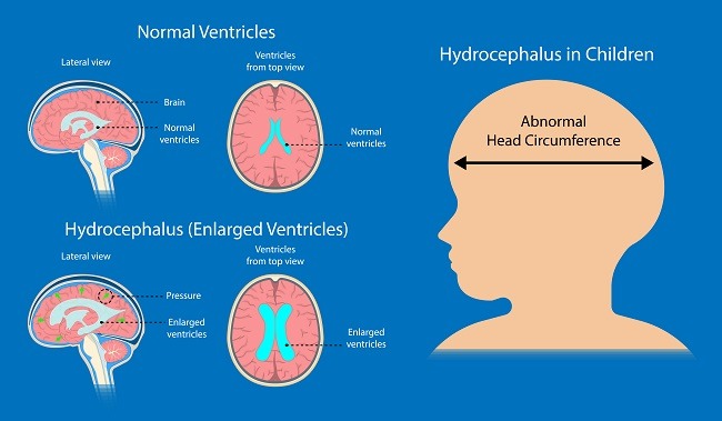 Hydrocephalus Patofisiologi Diagnosis Penatalaksanaan Alomedika Porn Sex Picture