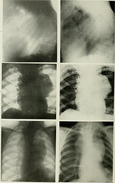 Pelebaran Mediastinum pada Rontgen Thorax Pasien Dewasa - Alomedika