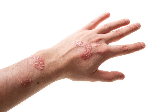 Neurodermatitis - patofisiologi, diagnosis, penatalaksanaan - Alomedika