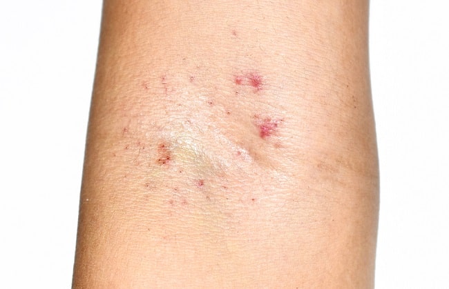 Nilai Diagnostik Tes Rumpel Leede untuk Demam Dengue - Alomedika