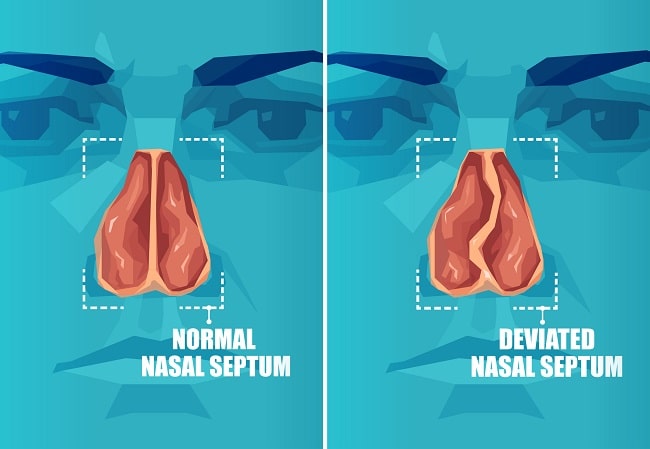 Deviasi Septum Nasal - patofisiologi, diagnosis, penatalaksanaan - Alomedika