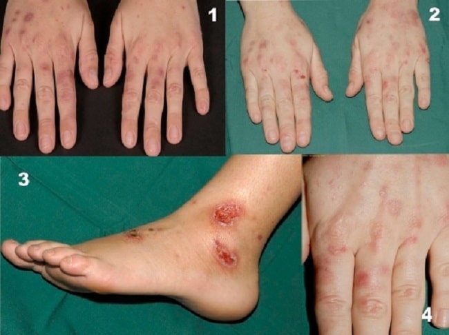 Porfiria - patofisiologi, diagnosis, penatalaksanaan - Alomedika