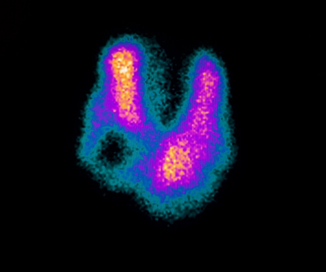 Peran Thyroid Scintigraphy dalam Mendiagnosis Kelainan Tiroid - Alomedika
