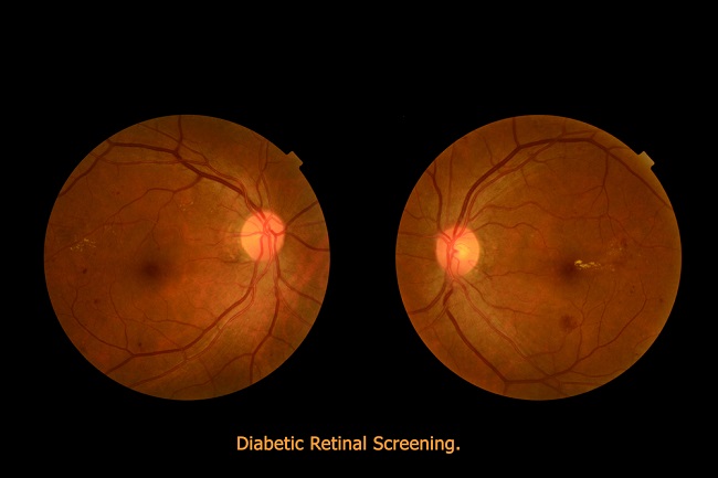 Skrining retinopati diabetik – Purchasing home & healthcare