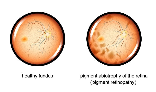 Retinitis Pigmentosa - patofisiologi, diagnosis, penatalaksanaan ...